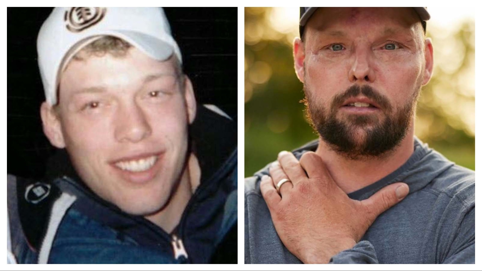 How A Face Transplant Gave A Newcastle Man A New Smile And Life ...